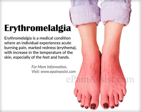 What Is Erythromelalgiacausessignssymptomstreatmentsurgerydietdiagnosis