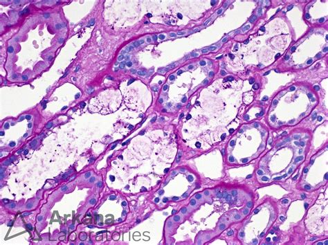 Armani Epstein Anomaly Ismms Nephrology Fellowship