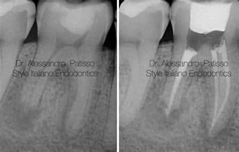 Treatment Of An External Inflammatory Root Resorption Style Italiano Endodontics