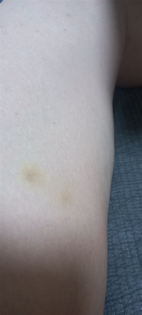 이유없는 다리 멍 지식in