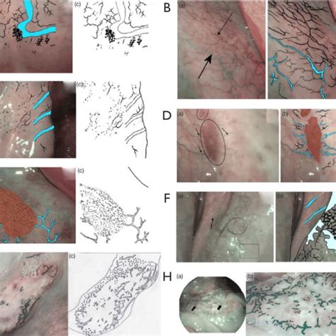 The Ni Classification 2019 Classification Of Vocal Cord Leukoplakia Download Scientific