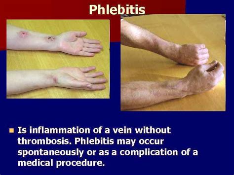 Acute Purulent Infections Of Soft Tissues A