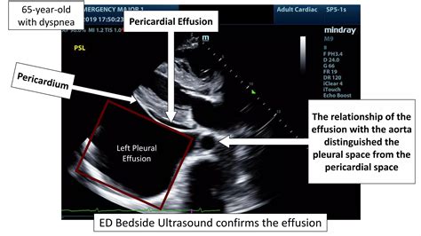 Emguidewires Radiology Reading Room Pleural Effusions Pptx