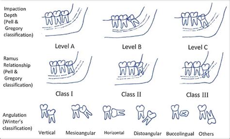 Impaction Classifn Ace Achievers