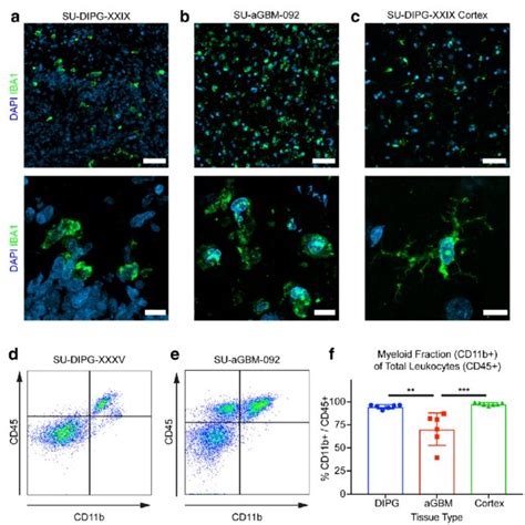 DIPG And AGBM Tumor Associated Microglia Macrophages A C