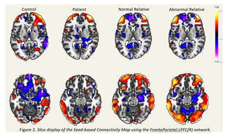 Multimodal Neuroimaging To Probe Brain Networks In Cervical Dystonia Mds Abstracts
