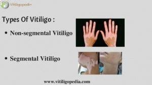 Segmental Vitiligo Treatment In Greater Kailash 1 New Delhi Id