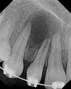 What Is The Apexification Omega Dental Houston TX