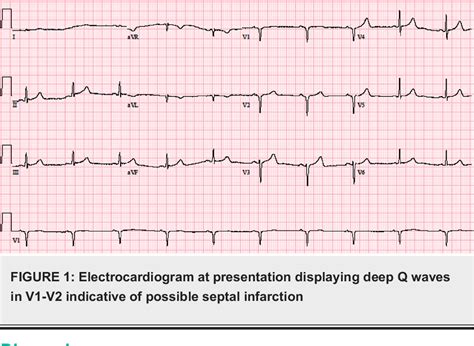 Figure 1 From A Pseudo Infarction Pattern In The Setting Of Esophageal