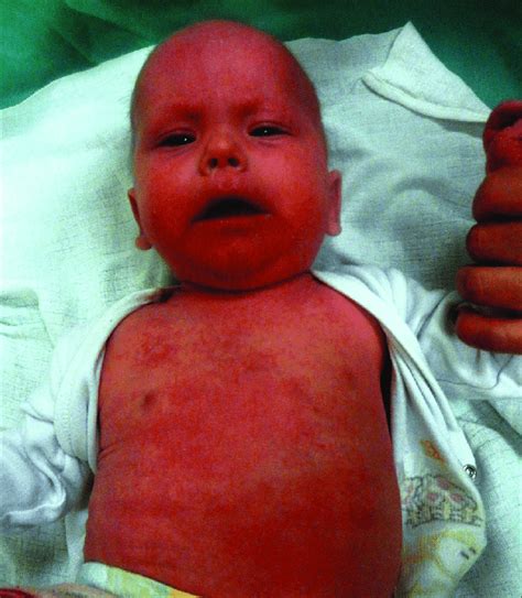 Facial Dysmorphic Features Resulting From Ichthyosis Download