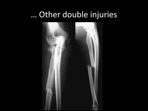 Σύνθετα Κατάγματα του Αγκώνα Complex Fractures Of The Elbow Ppt