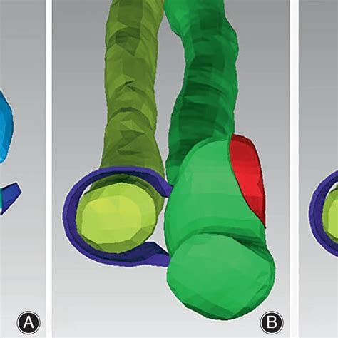 Ac 3d Digital Anatomy Models Of Reganmorry Classification Of Ulnar
