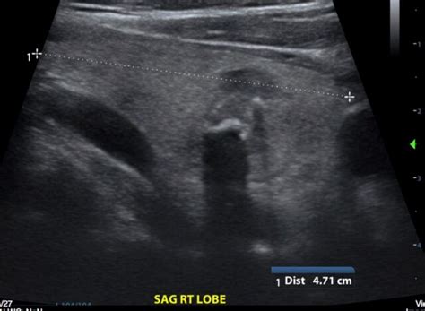 Thyroid Palpable Nodule Undergradimaging Nc Commons