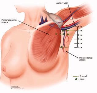 Lymph Node Armpit