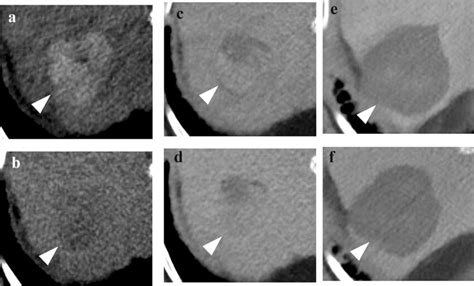 A 63 Year Old Patient Presents With A 4 1 Cm Segment 7 Li Rads 5 Download Scientific Diagram