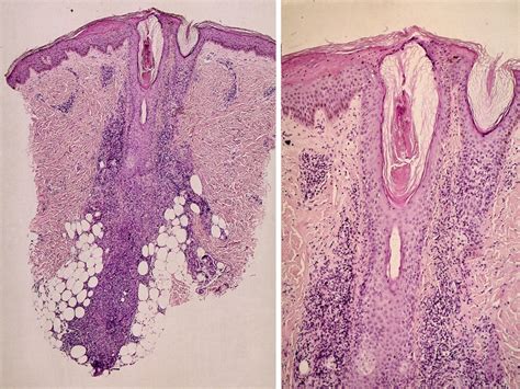Folliculitis Door S Aureus