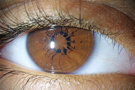 Persistent Pupillary Membrane Ppm Is A Condition Of The Eye Involving Remnants Of A Fetal