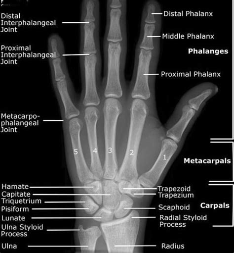 Types Of Fractures Understanding Bone Injuries The Nursing School Artofit