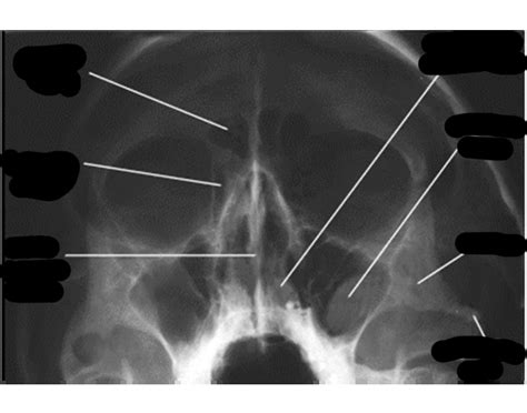 Parietoacanthial Waters Method Orbits Quiz