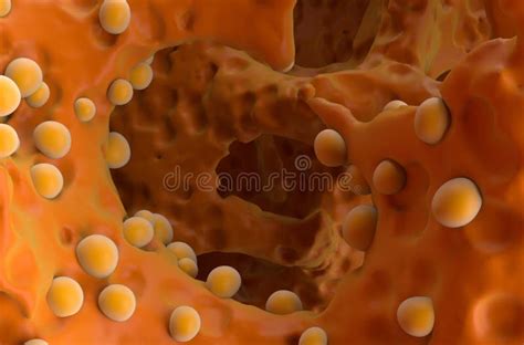 Bone Cancer Osteosarcoma Closeup View 3d Illustration Stock
