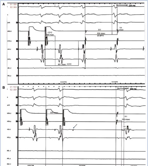 A Programmed Single Atrial Stimulation 500 340 Msec Showing Download Scientific Diagram