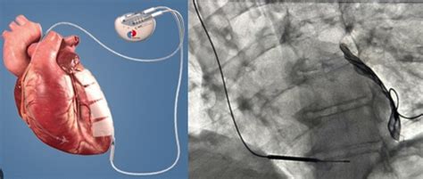 Na Kcus Prvi Slučaj Ugradnje Uređaja Za Mikrostrujnu Terapiju Srca