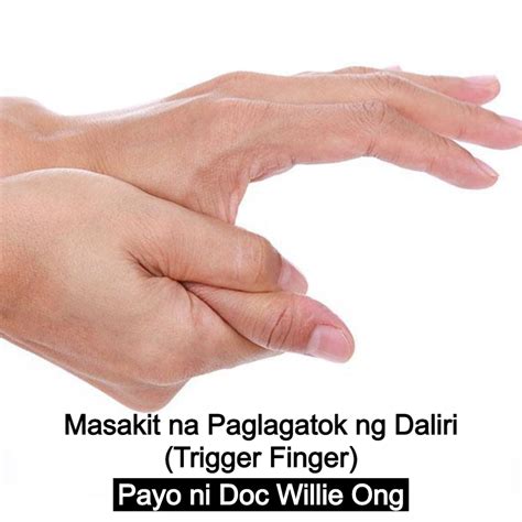 Doc Masakit Na Paglagatok Ng Daliri Trigger Finger Payo Ni Doc
