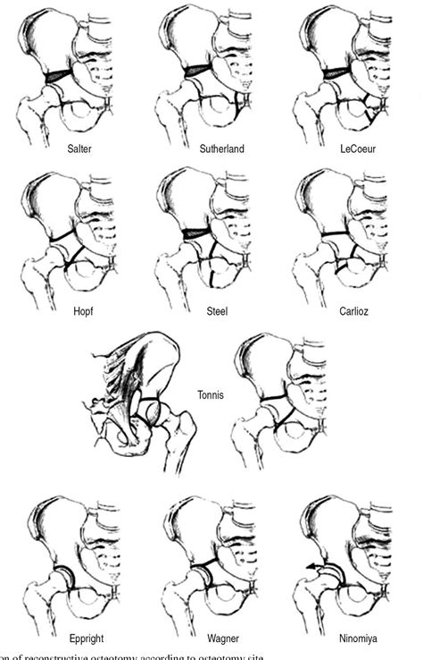 Figure 3 From Osteotomy Around The Hip Joint Semantic Scholar