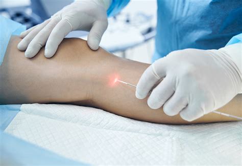 Penanganan Varises Dengan Laser Evla Di Rs Pondok Indah Rs Pondok Indah