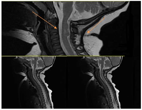 Asymptomatic Isolated Congenital Cervical Dermal Sinus