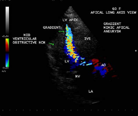 Apical Left Ventricular Long Axis View Showing The Gradient In Lv Apex Download Scientific
