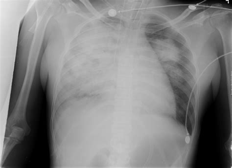 Chest X Ray Revealing Bilateral Diffuse Opacity Predominantly In The Download Scientific