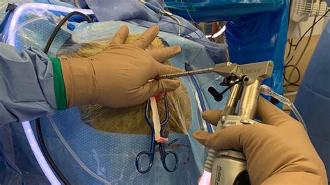 Hydrocephalus Ventriculostomy