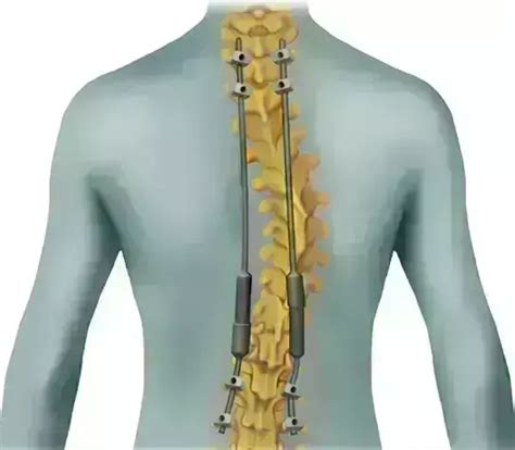 Dual Growing Rods Effective In Treating Severe Early Onset Scoliosis In