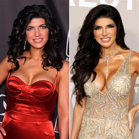 Teresa Giudice And The Buzz Around Her Plastic Surgery Journey Bizrahmed