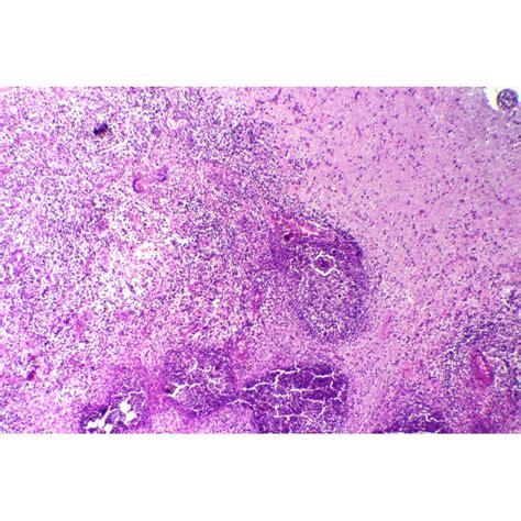 Brain Abscess Sec Medical And Science Media