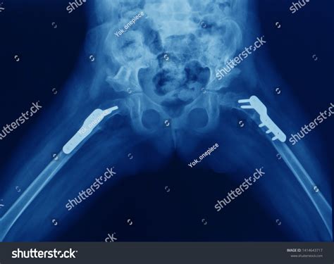 Hip Dislocation Test Photos And Images Shutterstock