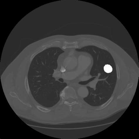 Lung Cancer Detect Object Detection Dataset By Whiteblood