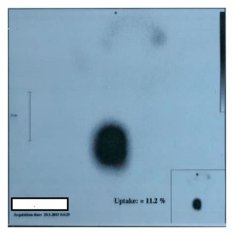 Technetium Thyroid Scan Showing Autonomous Hot Nodule With