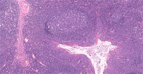 Tonsil Normal Histology Nus Pathweb Nus Pathweb