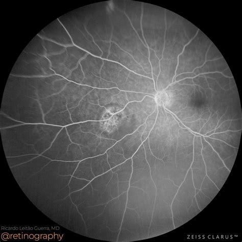 Choroidal Metastases Retinography