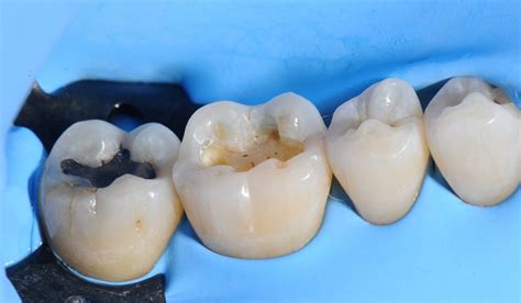 Clinical Case By Dr Max Andrup Amalgam Replacement Using An