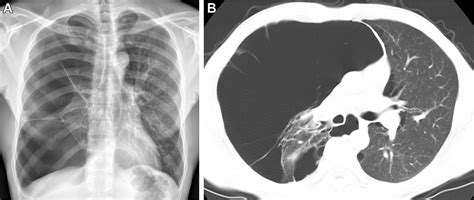 Lung Hyperlucency Chest Lung Hyperlucency Chest