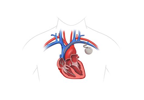 Implantable Cardioverter Defibrillator Vs Pacemaker