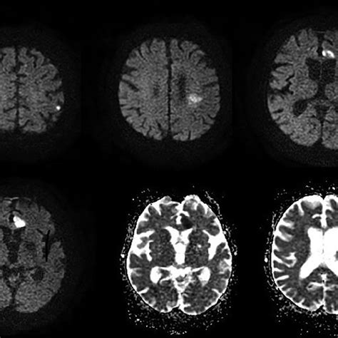 Diffusion Restriction Areas Observed In Dwi Of Patient 1 Download Scientific Diagram