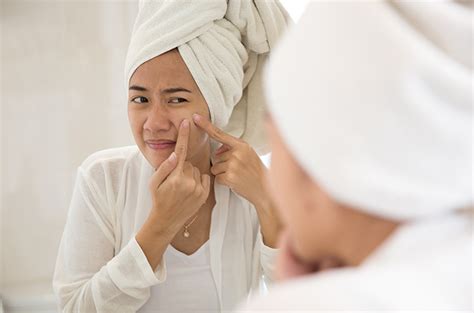 Perlu Tahu Cara Menghilangkan Bekas Jerawat Dengan Cepat