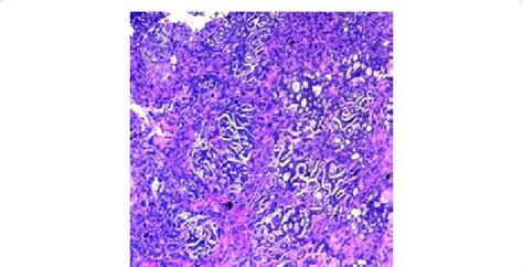 Histopathological Section Showing Monomorphic Cells Arranged In