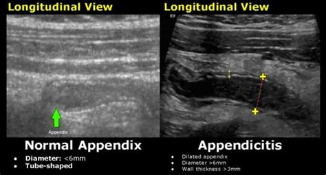 Acute Appendicitis The Chameleon Of Surgery
