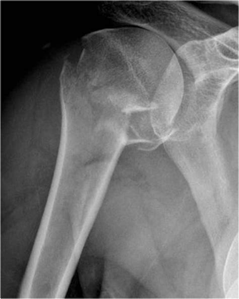 Proximal Humerus Fracture Preoperative Download Scientific Diagram