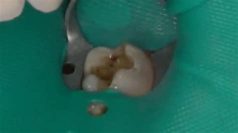 Clinical Demonstration Class Ii • Part I